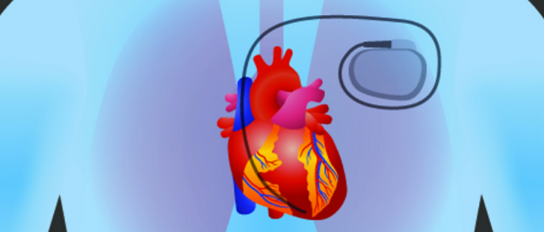Georgian Technical University Pacemakers Powered By Light ...